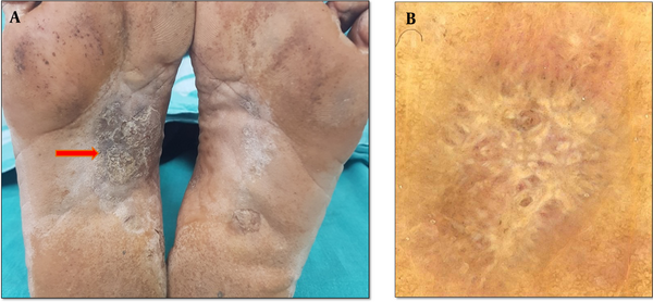 Clinical and Dermoscopic Studying of Palmoplantar Keratodermas ...