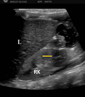 Hypochloremic Metabolic Alkalosis in an Infant with Diarrhea