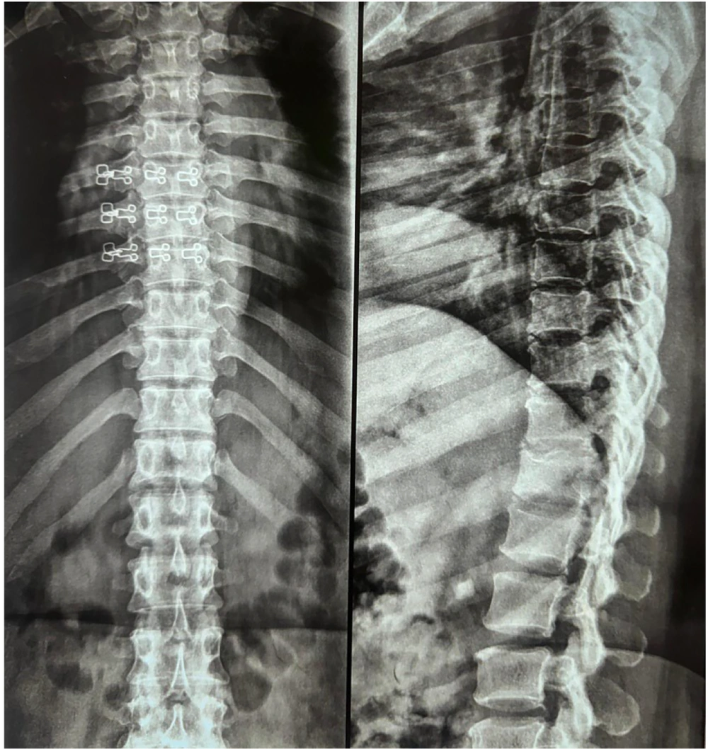 Beyond Inflammation: Early Thoracic and Lumbar Spine Involvement in a ...