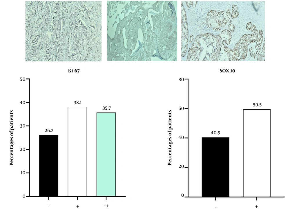 Ki-67 and SOX-10 Expressions in Breast Cancer Patients – Their ...